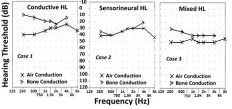 Variation Of Hearing Threshold With The Frequency For Three Main Download Scientific Diagram