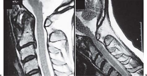 19 Image Guided Surgery In The Craniovertebral Junction And Upper