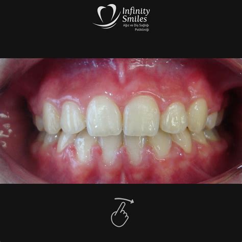 حالة تقويم قبل وبعد في عيادتنا تقويمأسنان تقويمالأسنان