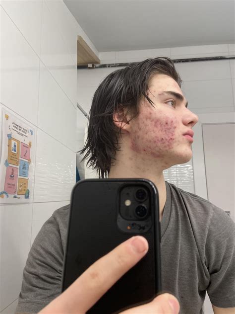 Before And After Doxycycline Treatment R Acne