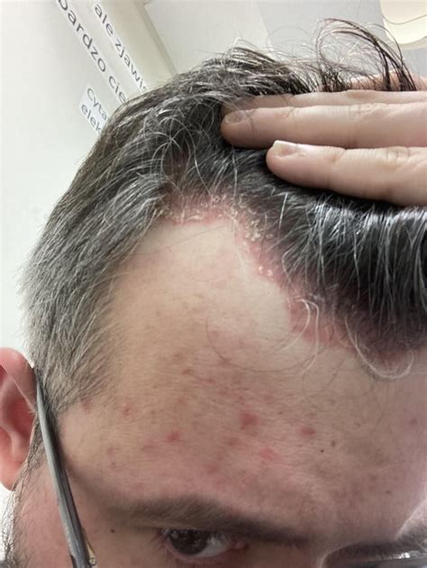 Scalp Psoriasis Update More In Comments R Psoriasis