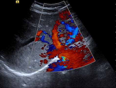 Figure 4 From Doppler Ultrasound In Budd Chiari Syndrome Semantic