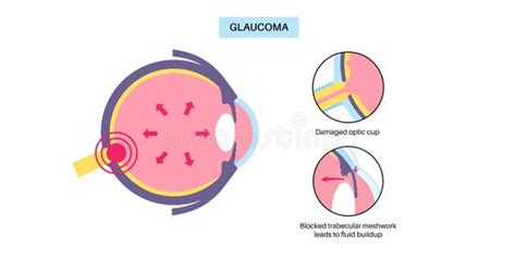 Glaucoma Ilustración Del Vector Ilustración De Lente 332449745