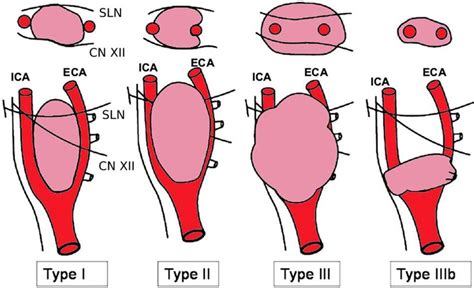 Shamblin Classification Modified By Luna Ortiz Download Scientific Diagram