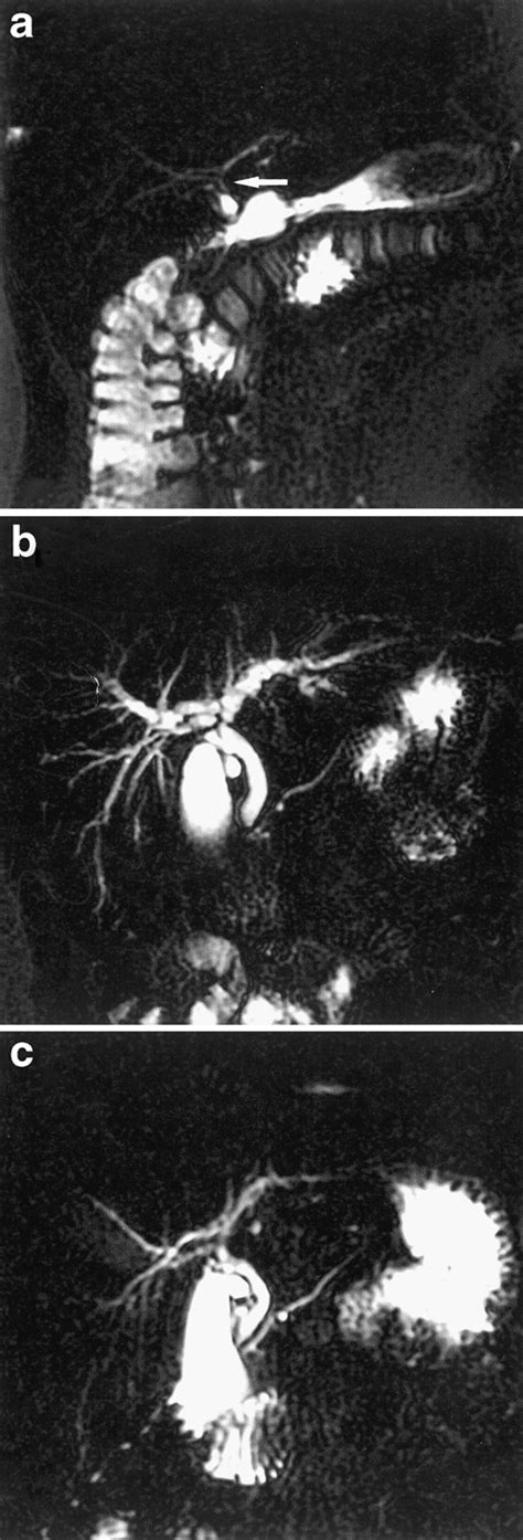 mr cholangiogram from patient b at 7 years of age before download scientific diagram