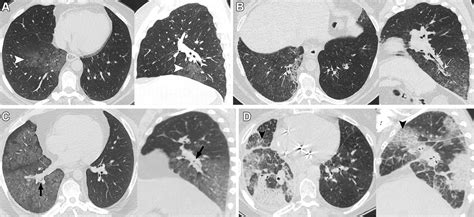 Ct Features Of Lymphatic Plastic Bronchitis In Adults Correlation With