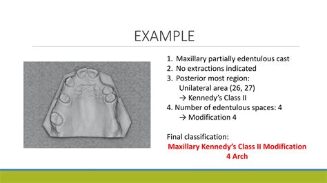 Kennedys Classification In Cast Partial Denture Pptx