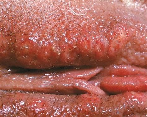 Genital Herpes Causes Signs Symptoms Home Remedies And Treatment