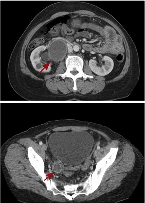 Figure 2 From A Rare Case Of Pyonephrosis Resulting From Tension Free