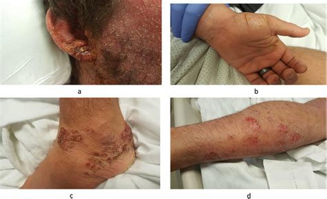 Diffuse Erythematous Rash