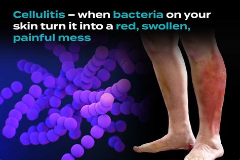 Cellulitis From Bug Bite On Foot Cheap Sale