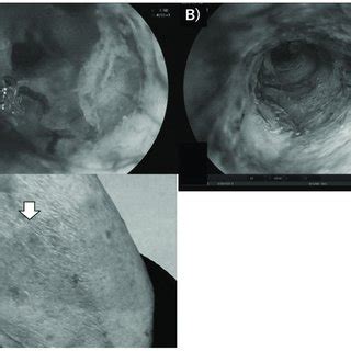 A Cholangioscopy Findings Showed Encircled Cancer Stenosis B Download Scientific Diagram