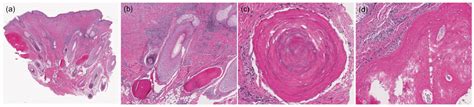 A Case Of Secondary Osteoma Cutis Associated With Lichen Planopilaris