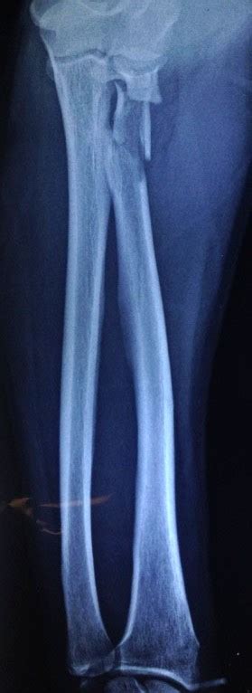 O R T O C R I T I C A Fractura Proximal Segmentaria De Radio Proximal