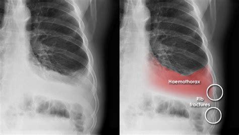 Rib Fracture Causing Pneumothorax At Clinton Richardson Blog