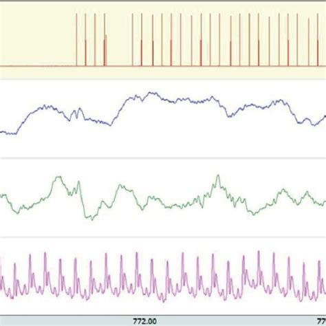The Electrocorticogram Ecog And Electrocardiogram Ecg Activity Download Scientific Diagram