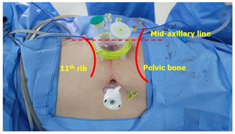 Retroperitoneal Single Port Robot Assisted Nephroureterectomy With