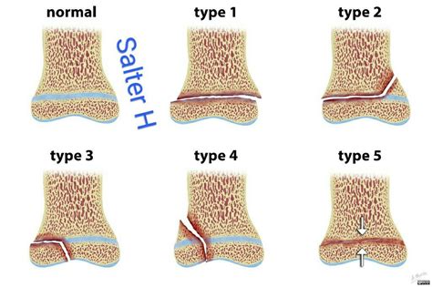 Weber Classification Of Ankle Fractures Artofit