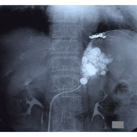 Radiograph After Embolization Of The Gastric Varices Demonstrates
