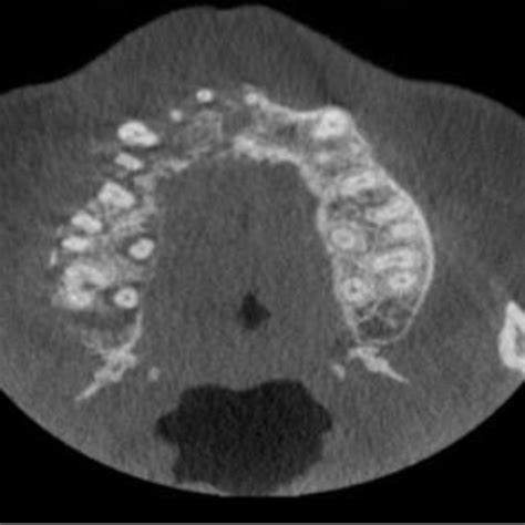 Ethmoid Sinus Showing Mild Haziness And Thickening Of Sinus Lining Download Scientific Diagram
