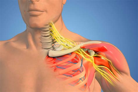 Brachial Plexus Injury Treatment In India Plexus