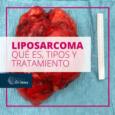 Liposarcoma ¿qué Es Cómo Se Diagnostica Y Cuál Es Su Tratamiento
