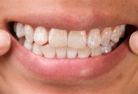 How To Fix White Spots On Teeth Contemporary Cosmetic Dentistry