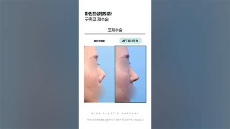 구축코재수술 Beforeandafter 전후 변화 마인드성형외과 Youtube