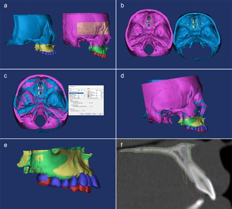 Superimposition Of T1 And T2 Models With The Cranial Base The T2