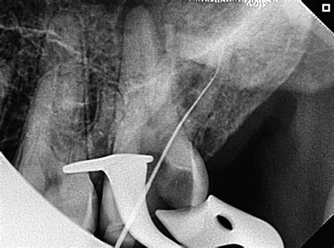 Ledge Bypass Myzerodonto