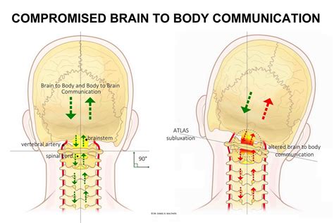 Torticollis Diagram