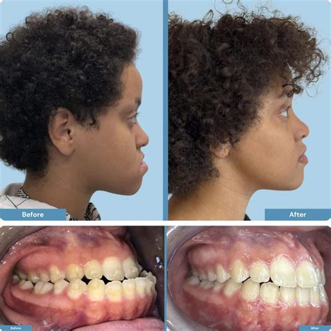 Orthognathic Jaw Surgery Before And After At Eldon Berthold Blog