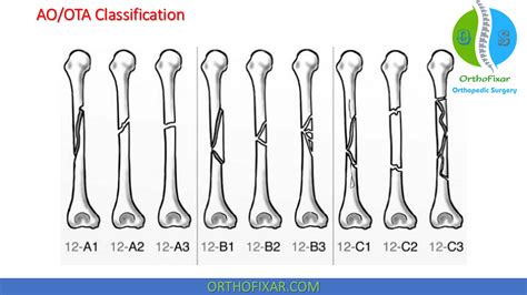 Humeral Shaft Fractures Orthopedic Learning