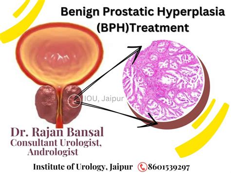 Benign Prostatic Hyperplasia Benign Prostatic Hyperplasia…a Health