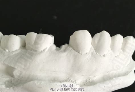 即刻种植一例 医联