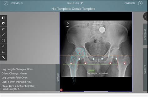 Screenshot Of Velys™ Preoperative Templating With Estimated Implant Download Scientific Diagram