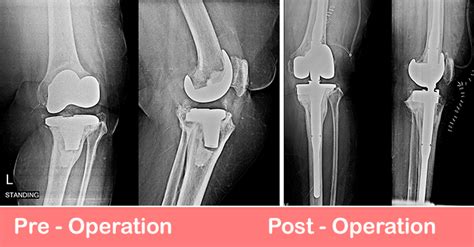 Revision Total Knee Replacement Rhk Sant Parmanand Hospital
