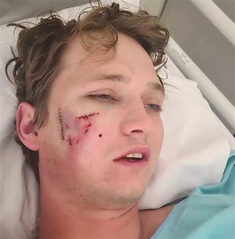 Man Attacked By Hyenas While Sleeping At Bachelor Party Survived
