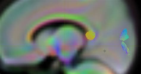 Finding The Fissure Calcarine On Neonate Dti Imaging Mrtrix3 Community