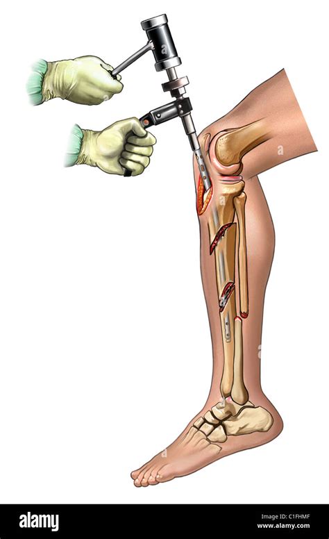Titanium Rod Removal Tibia At Gail Pagano Blog
