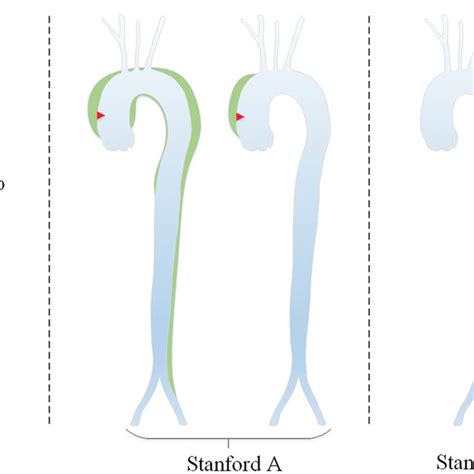 Stanford Classification Of Aortic Dissection Download Scientific Diagram