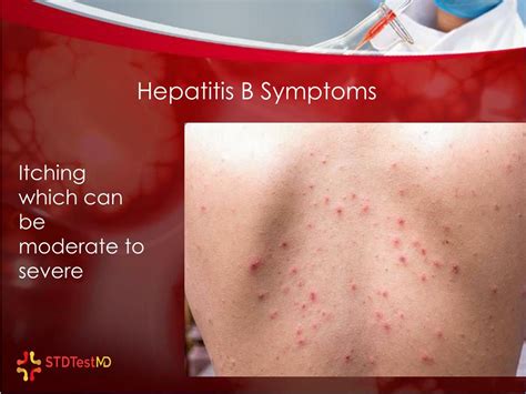 Ppt 10 Common Symptoms Of Hepatitis B Infection Powerpoint Presentation Id 7541208