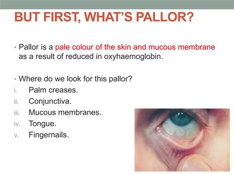 Approach To Pallor Full Compilationpptx