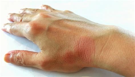 Lupus Eritematoso Cutáneo Síntomas Y Tratamiento Cio Salud