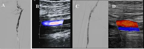 Arterial Duplex Scan And Computed Tomography Angiography Showed The Download Scientific Diagram