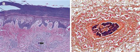 Septic Vasculitis From A Femoral Artery Catheterization Rheumatology