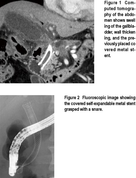Figure 1 From Endoscopic Transpapillary Gallbladder Drainage With
