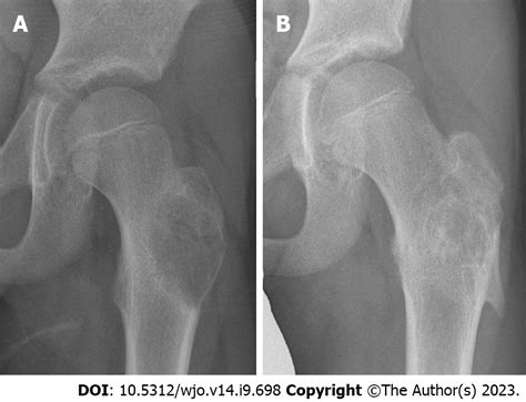 Aneurysmal Bone Cyst Tibia