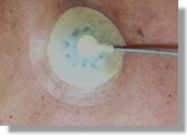 Ecg Noise Reduction Health Science Technologies