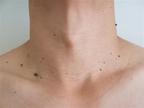 Warts And Moles Causes Types And Treatments Lavish Clinic